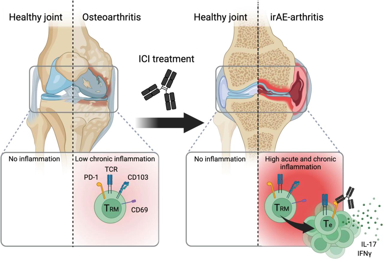 Osteoarthritis increases the risk of inflammatory arthritis due to ...