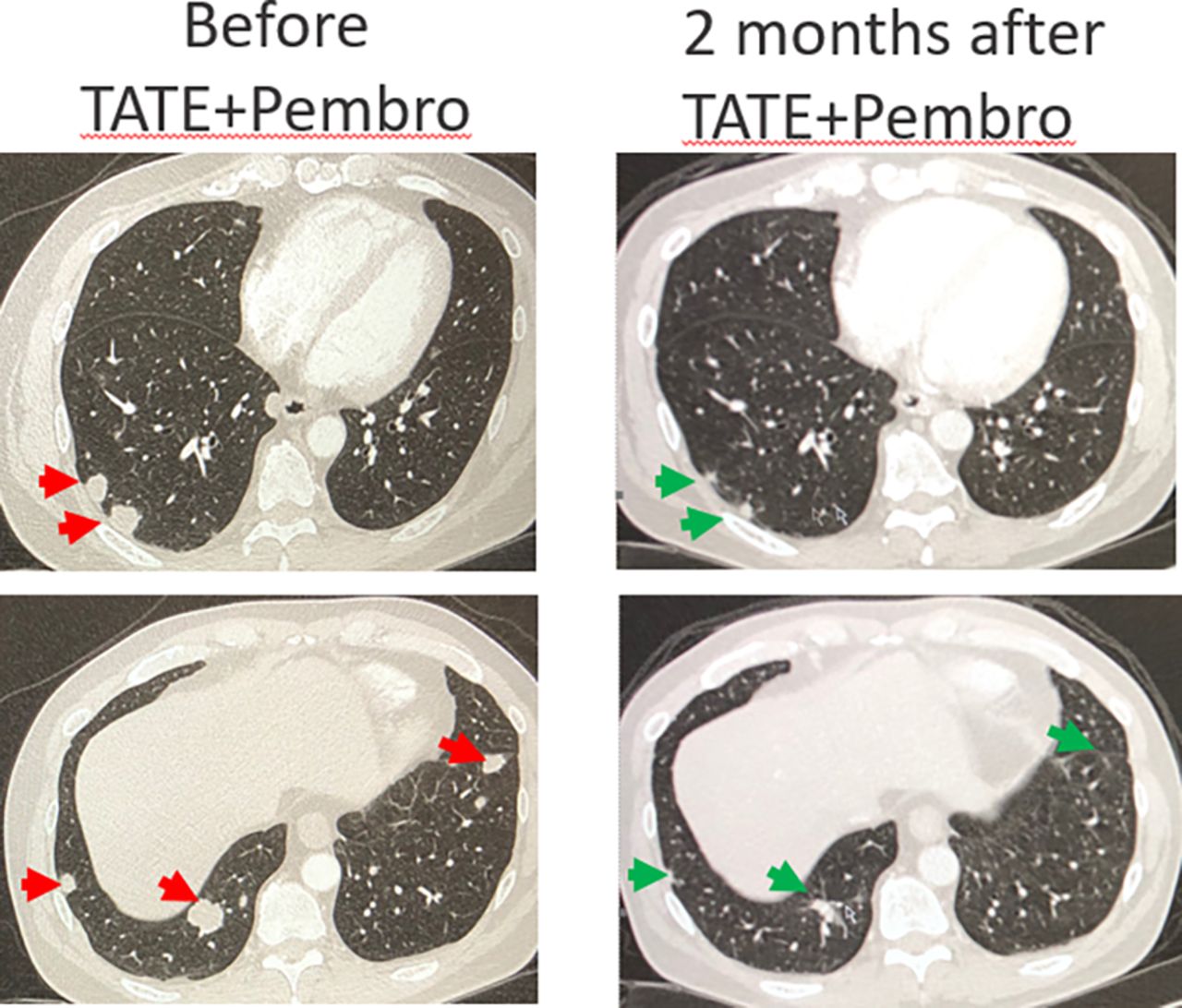 492 Phase 2 single-arm study of trans-arterial tirapazamine ...